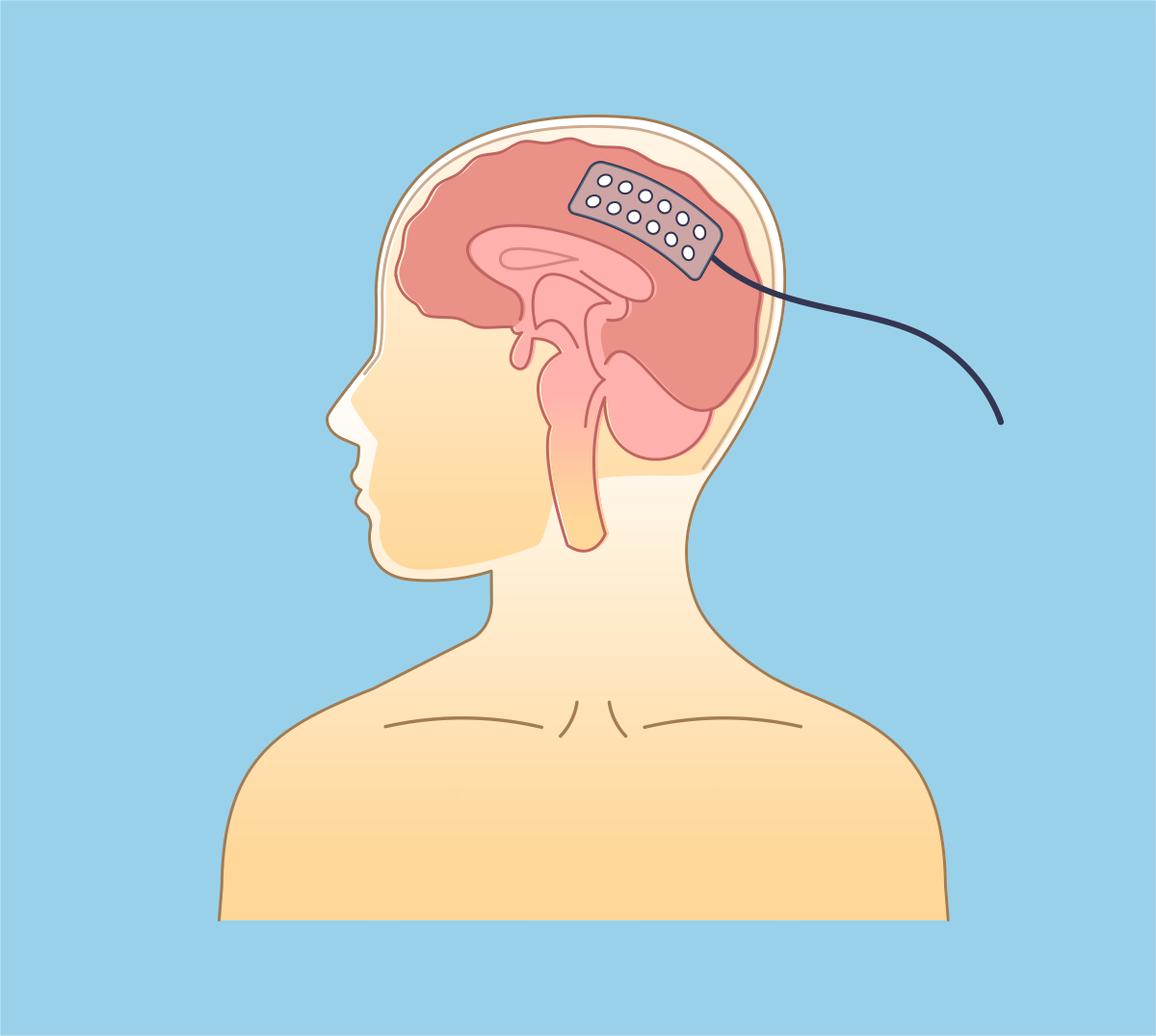 Evaluaciones Especializadas e Invasivas - ItsYourEpilepsy.com