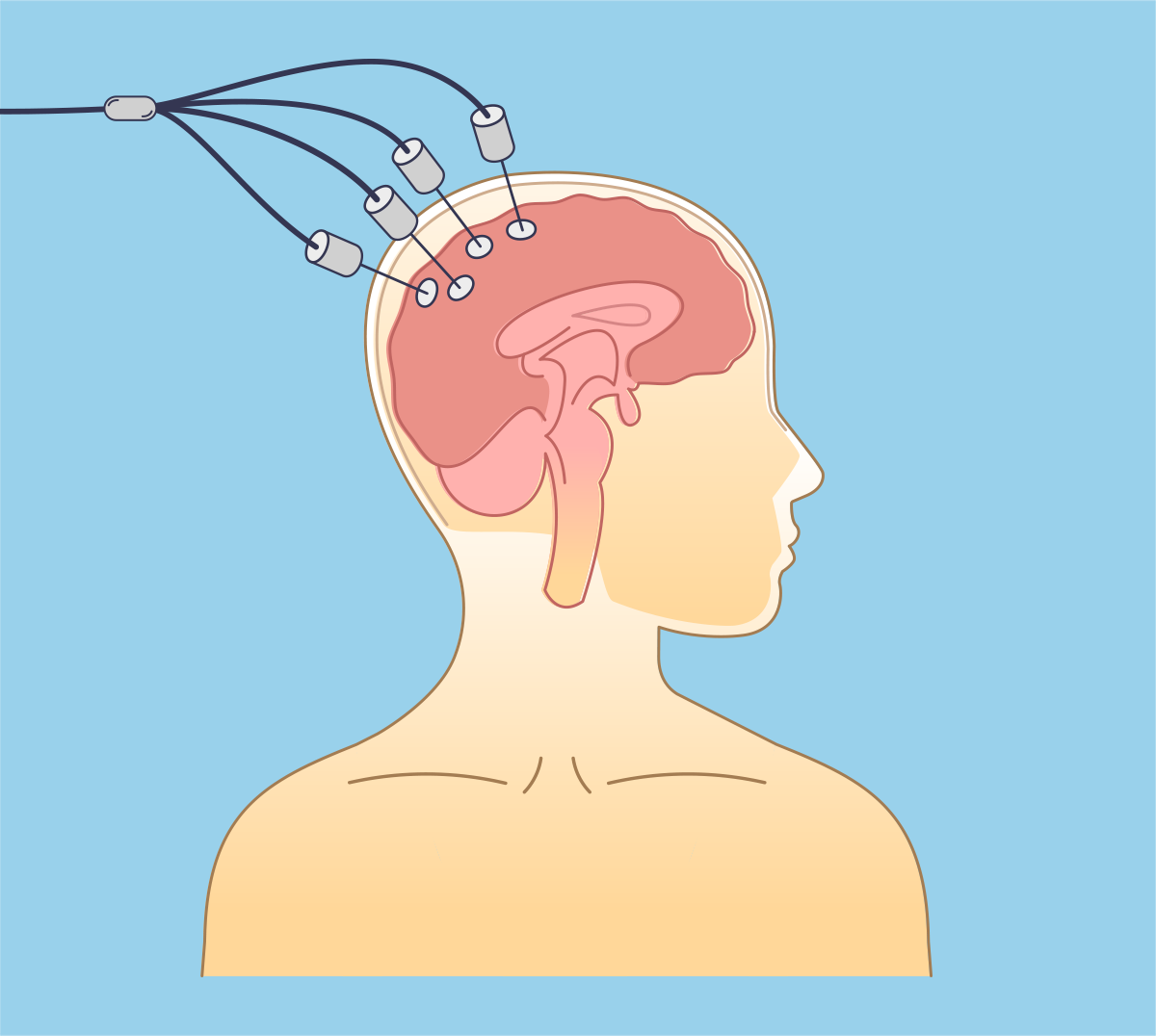 Evaluaciones Especializadas e Invasivas - ItsYourEpilepsy.com